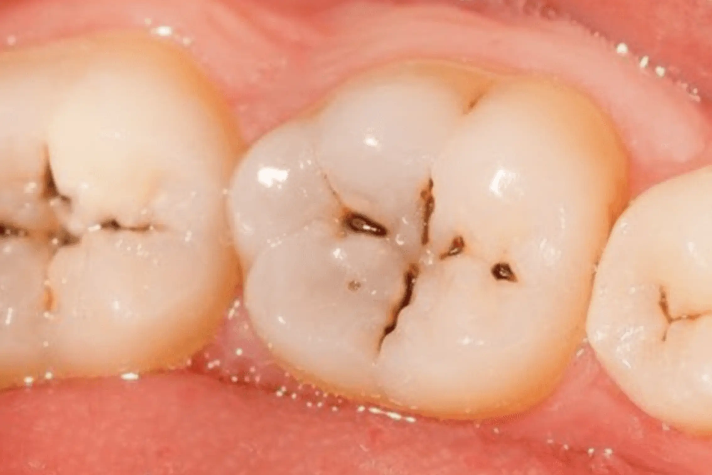 Caries Teeth What Causes Cavities In Teeth? BGW Dental Group